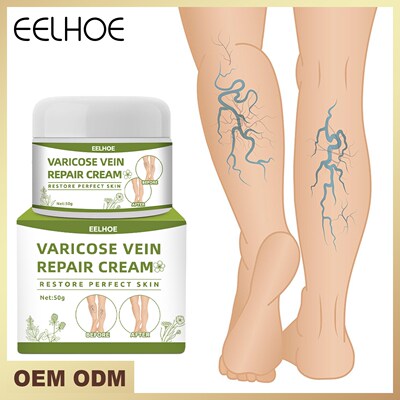 Varicose Veins Cream Varicose Vein Treatment Cream For Legs