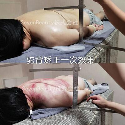 骨盆矫正尺量背尺徒手整形尺