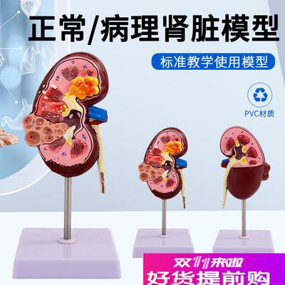 人体肾解剖模h型病变肾脏模型病态肾脏人体内脏器官解剖模型