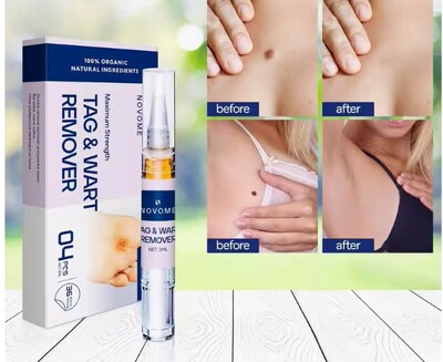 Removing Agat Moles Liquid Pen Treatment Papillomas Removal