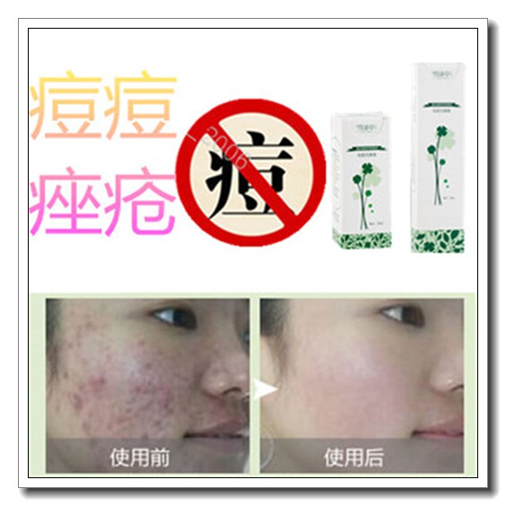 去除脸上部闭口粉刺深层清洁湿敷水洗面奶消祛额头痘疤痘印药膏贴