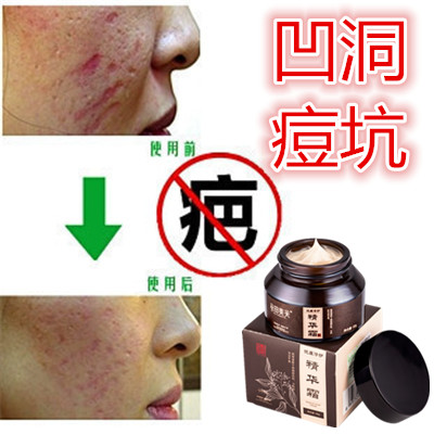 草本祛凹陷痘疤痕灵男女士凹洞快速祛凹坑痘印粉刺坑淡化痘坑产品