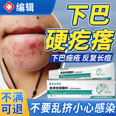 下巴反复长痘闭口粉刺痤疮膏