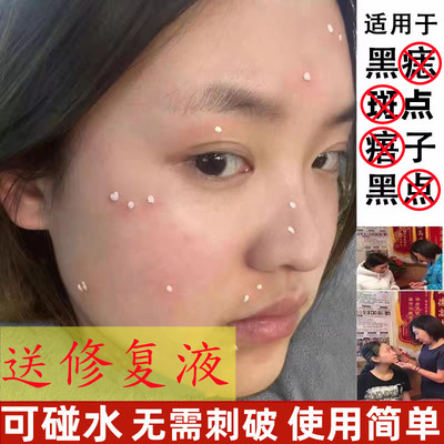 取脸部黑痣肉痣凸痣膏斑点痦子点药水痕雀正品美容院专用仪神器