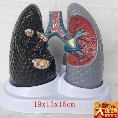 人体吸烟癌变肺模型 健康肺模型人类内脏L 吸烟肺与健康肺模型