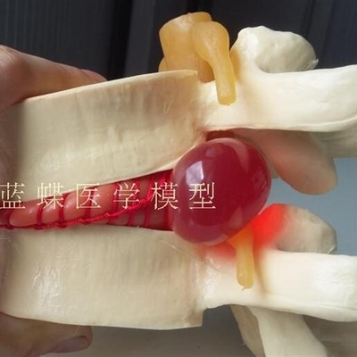 Lumbar disc herniation Human anatomy skeleton Spine model Te