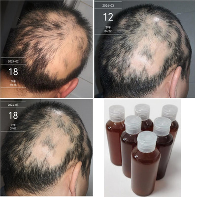 斑秃中药酒安全无副男女儿童可用