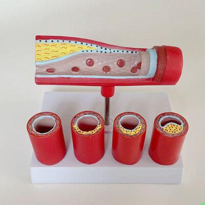 康泰模型动脉血管壁粥样硬化红细胞脂肪斑块阻塞狭窄心血管病理