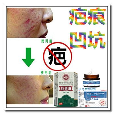 祛凹凸疤去除黑色素沉淀红印伤疤贴淡化黑印痘疤痕印修复药膏正品