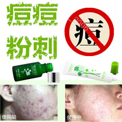 产品祛除面部男女修复精华液痘痘豆豆粉刺酒糟鼻正品前胸后背额头