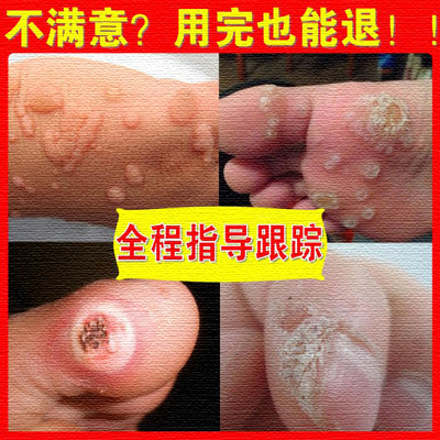 去祛瘊甲子周寻常丝状砣拓跖手足脚痦子肉刺脖瘊子肉粒灵专用神器