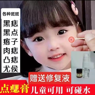 祛黑痣红痣痦子肉痣揪揪疣体黑点各种斑点无痕神器