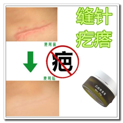 去除摔伤疤痕药膏产品修复舒疤宁硅酮凝胶消祛手术伤口愈合贴正品