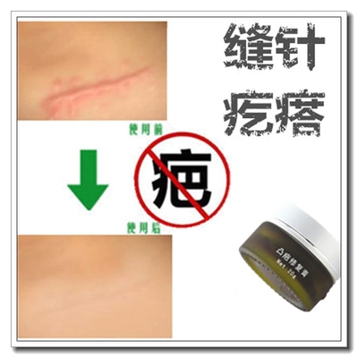 去除脸部伤疤痕的药淡化黑色素沉淀修复药膏正品祛儿童专用消平贴