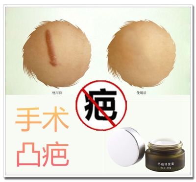 去除儿童专用增生性疤痕体质药膏祛耳洞凸起硬疙瘩液修复消平疤贴