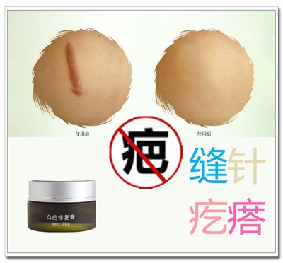 去除增生性凸起疤不得硅酮凝胶祛耳洞硬肉疙瘩疤痕体质修复药膏贴