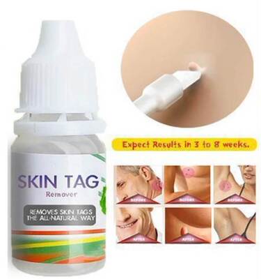 10ml Skin Tag Remover Wart Treatment Papillomas Removal Liqu