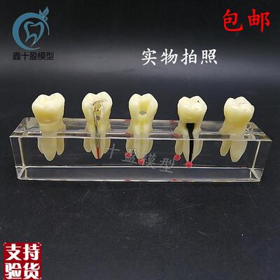 口腔教学b模具水晶根管治疗模型可拆修复牙冠龋齿蛀牙病理M4012