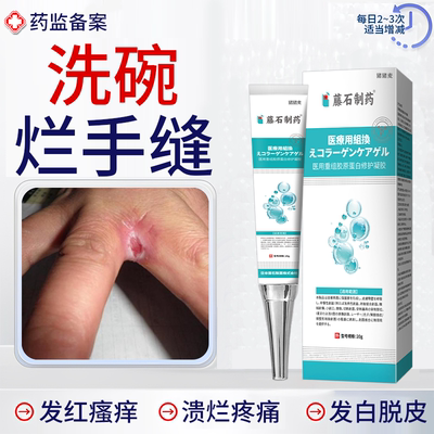 【创面愈合】长期泡水烂手丫凝胶