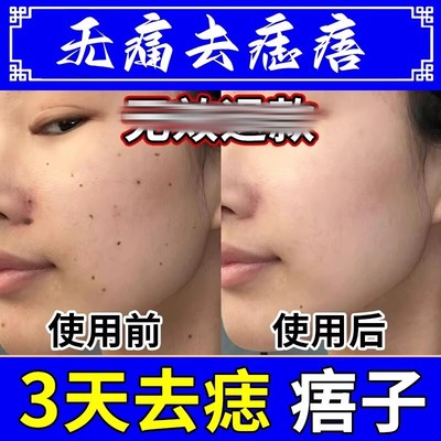 点痣药膏点痦子去痣取疣祛痣无痕