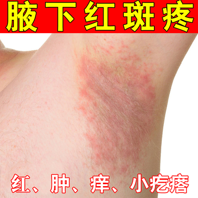 腋毛腋下红斑湿红肿长小疙瘩胳肢窝出汗发臭有红肿专用软膏