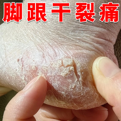脚后跟干裂脱皮鳞屑角化型脚底增厚干裂粗糙修护霜
