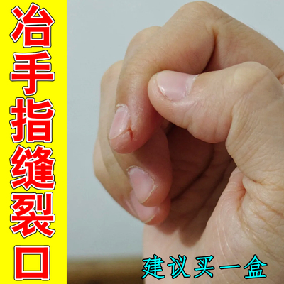 冶手指缝裂口手指头开裂口子流血疼痛指甲缝开裂修复药乳霜防干裂