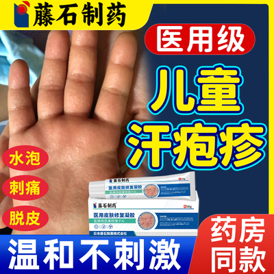 儿童汗疱疹膏手上起小水泡