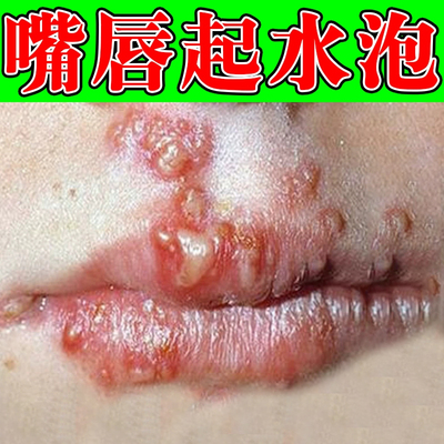 嘴角起泡口唇膏儿童成人嘴巴上火起泡烂红肿干燥开裂修复羊胡子疮