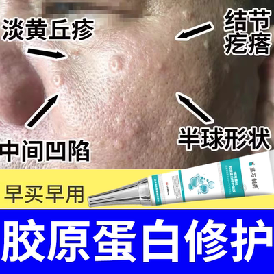 皮脂腺增生增大面部胸前囊肿黄色丘疹早熟性老年性脸上起小疙瘩DZ