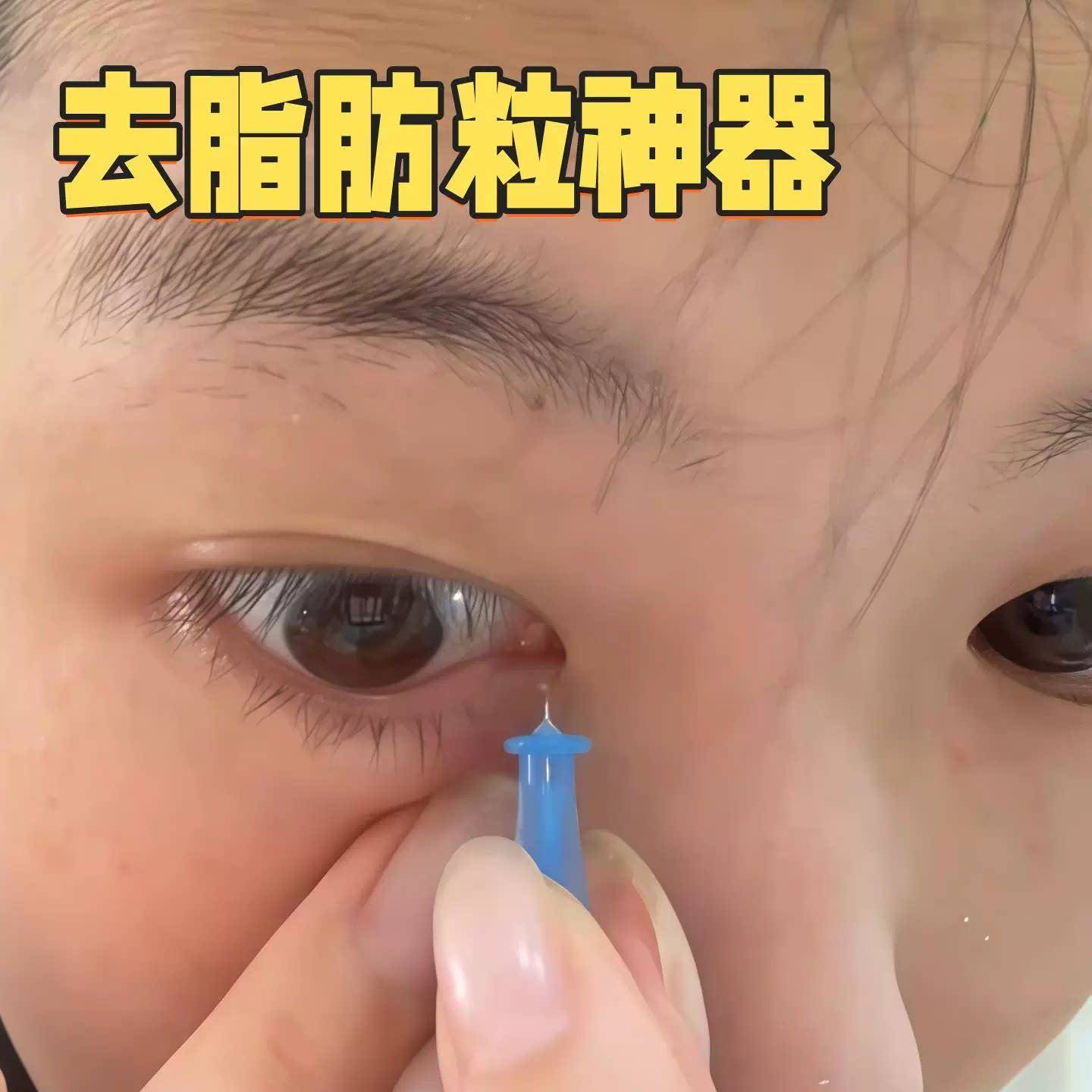 新手一次性粉刺针脂肪粒去除神器脸部油脂粒专用美容院闭口针护肤