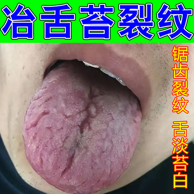 舌苔裂纹口腔不爽舌面发木不适草本护理药剂温和改善舌体紧绷干涩