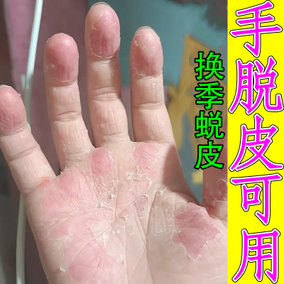手脱皮感染小孩手指头蜕皮手掌心脱皮指甲边缘发干发硬外用膏药乳