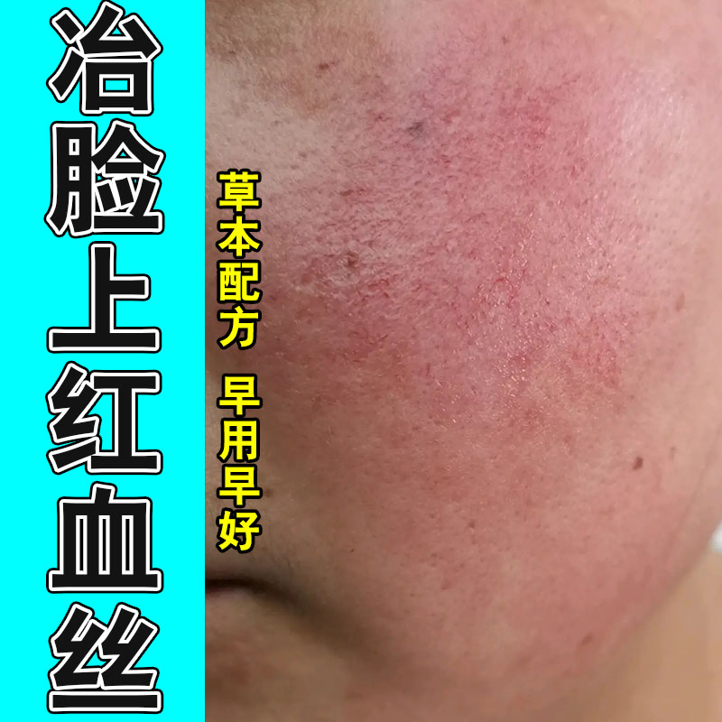 改善红血丝修复角质层增厚肌肤修复脸部泛红修护草本乳膏
