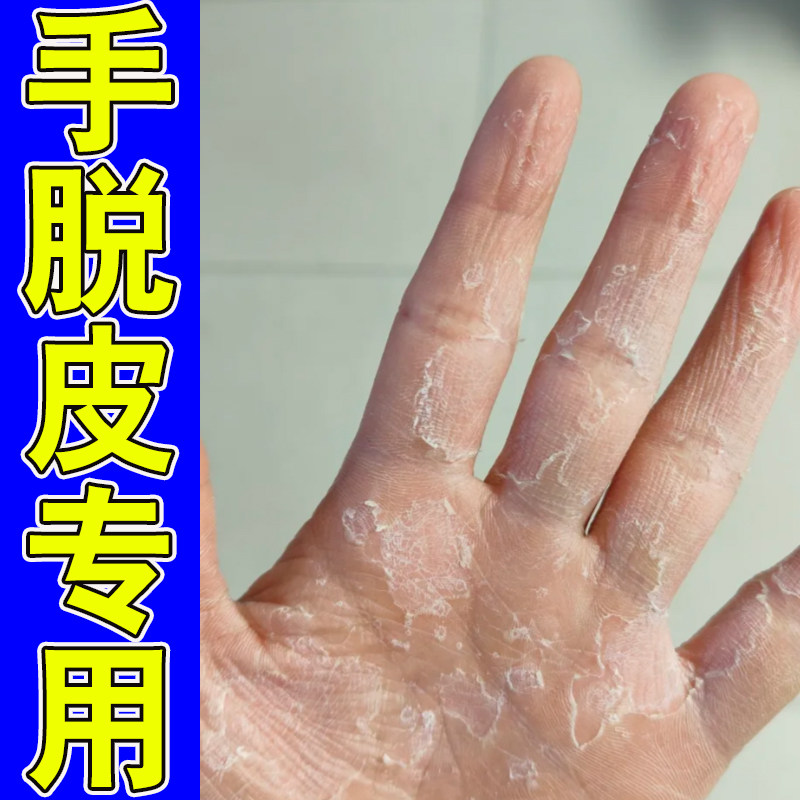 手起皮严重起皮专用真菌干燥起皮膏冶护手霜皮脚底干用膏
