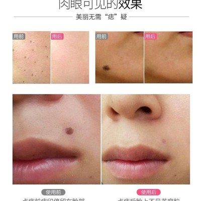 点痣去痣无痕药水去黑痣肉痣贴点斑膏祛痣神器修复黑点脸部笔