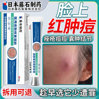 脸上疖肿结节硬块痘痘起硬疙瘩囊肿脓包型祛痘膏药房同售FT