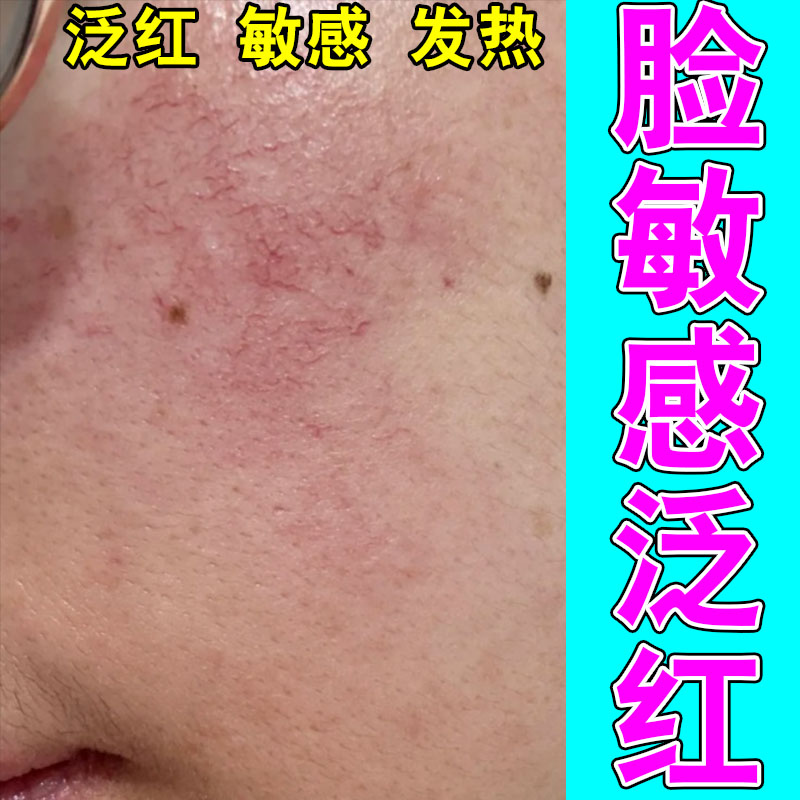 脸上的红血丝修复增厚角质层肌肤屏障受损修护脸红专用草本乳膏
