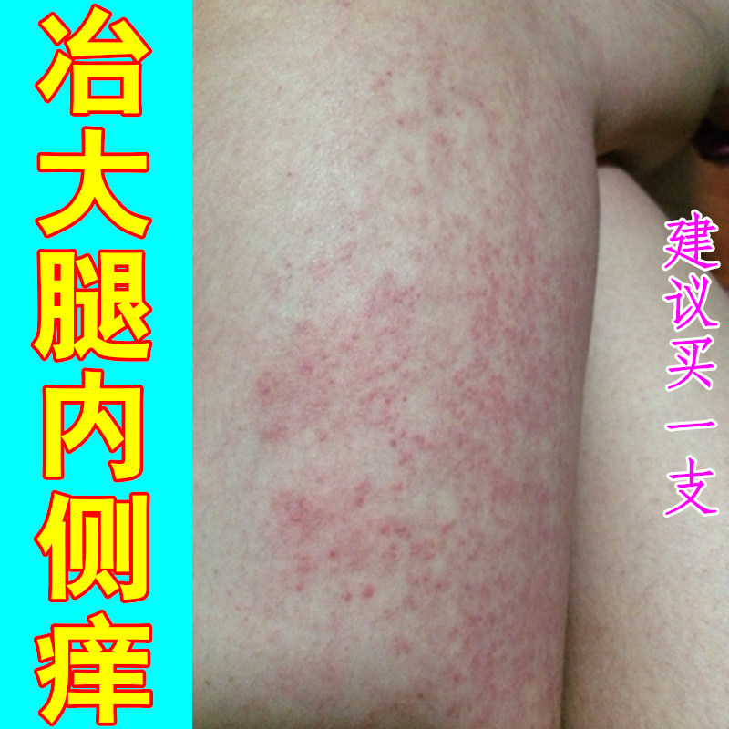 冶大腿内侧痒根部红斑潮屁股淹红皮肤痒子冶阴囊潮