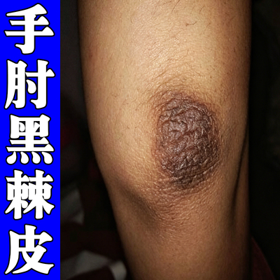 手肘黑棘皮外用去皮肤增厚粗糙发黑胳膊关节黑色素沉淀