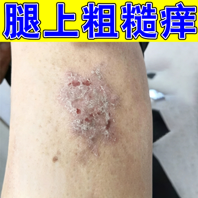 腿上粗糙痒皮肤真菌过敏干燥起皮掉皮屑外用身上痒长疙瘩外用软膏