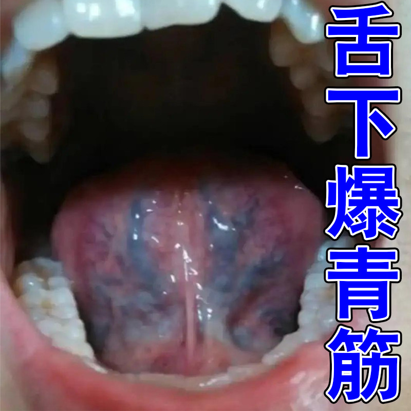 舌下青筋又黑又粗筋络发紫怒张清洁护理植物草本喷剂