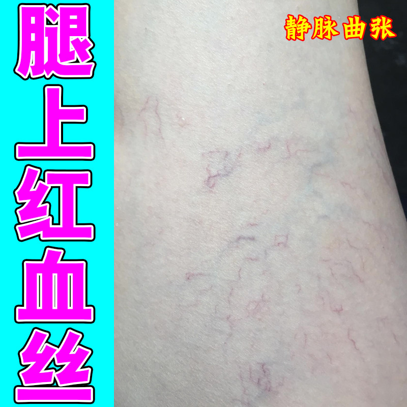 专用膏腿脚上有红血丝男女下肢血管堵塞肿胀毛细血管扩张