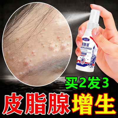 皮脂腺增生鼻子异位症嘴唇白点面部脂肪小颗粒皮肤屏障受损非修复