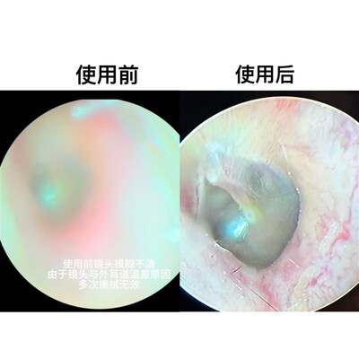 耳内镜镜头k防雾液可视采耳专用