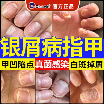 dr.avin官方正品【银屑病甲】