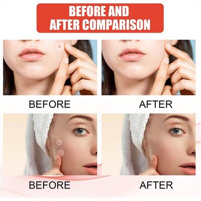 240Pcs New High-end Pimple Patch Acne Patches Heart/Star