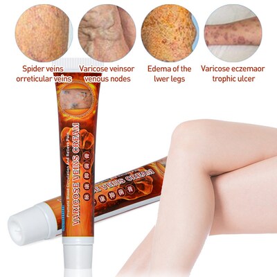 1/2Pcs 20g Varicose Veins Ointmnet Vasculitis Phlebitis Spid