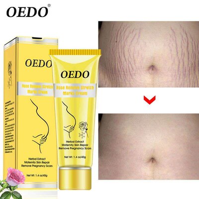 Rose Removes Stch Mark Cream To Remove Postpartum Obesity