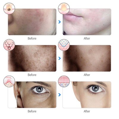 7 Colors Photon Facial LED Mask Red Light Therapy Anti Aging